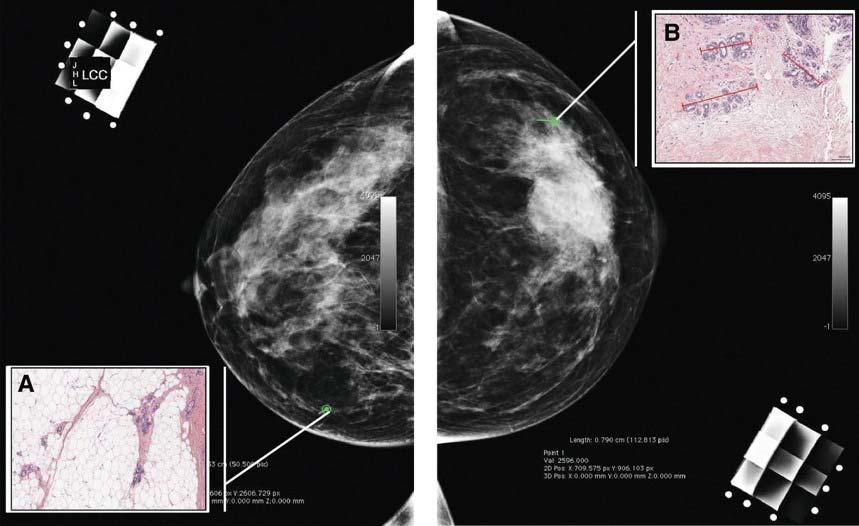 Exploring The Relationship Between Mammographic Breast Density And