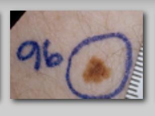 Moles to Melanoma: Recognizing the ABCDE Features - NCI