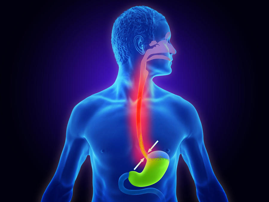Acid Reflux Disease and Cancer Risk - NCI